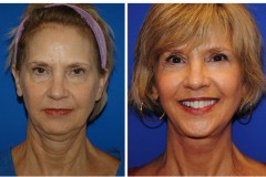 Face Gallery - Raj Plastic Surgery